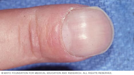 Slide show: 7 fingernail problems not to ignore - Mayo Clinic