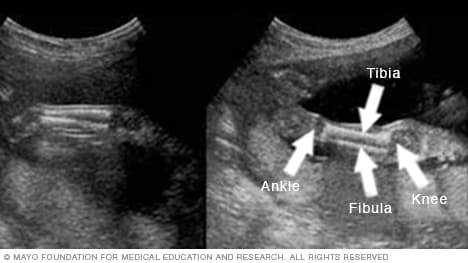 Slide show: Fetal ultrasound - Mayo Clinic